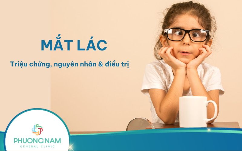 Mắt lác: Nguyên nhân, dấu hiệu và phương pháp điều trị