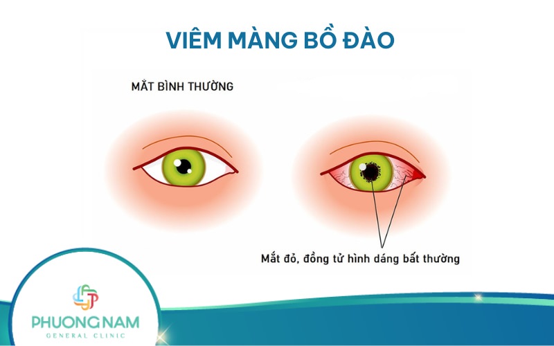 Viêm màng bồ đào: Nguyên nhân, triệu chứng và điều trị