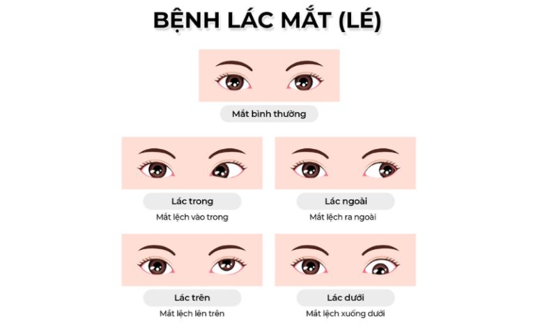 Mổ mắt lác: Chỉ định, phương pháp và quy trình phẫu thuật