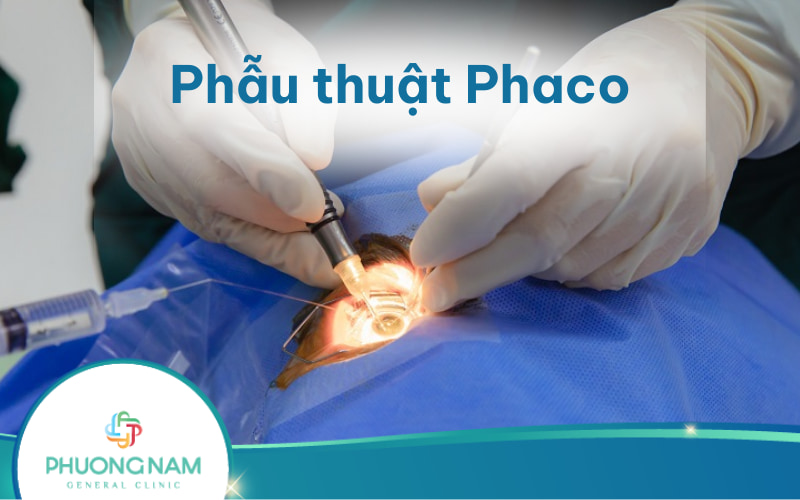 Phẫu thuật Phaco: Chỉ định, quy trình và cách chăm sóc