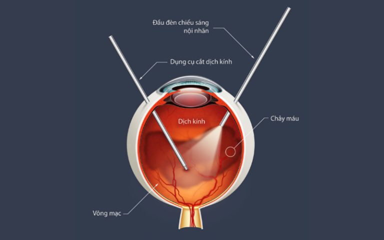 Ruồi bay trước mắt: biểu hiện, nguyên nhân và cách điều trị